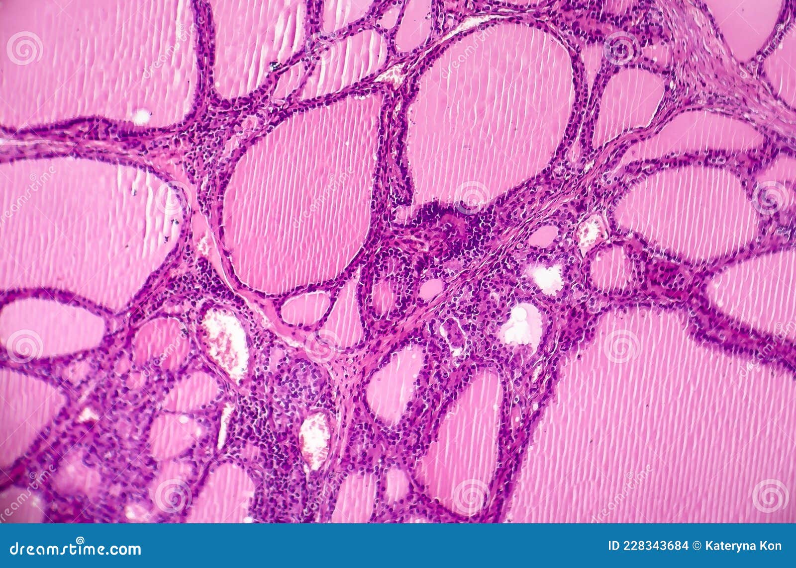 Toxic Diffuse Goiter, or Graves Disease, Light Micrograph Stock Photo ...