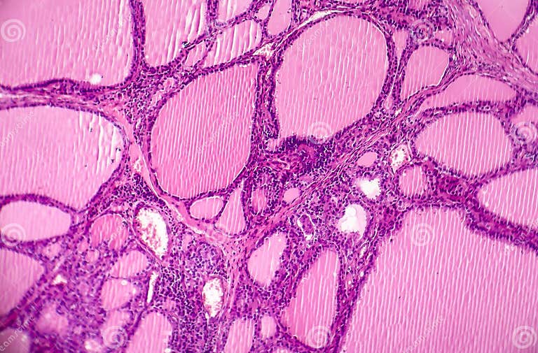 Toxic Diffuse Goiter, or Graves Disease, Light Micrograph Stock Photo ...