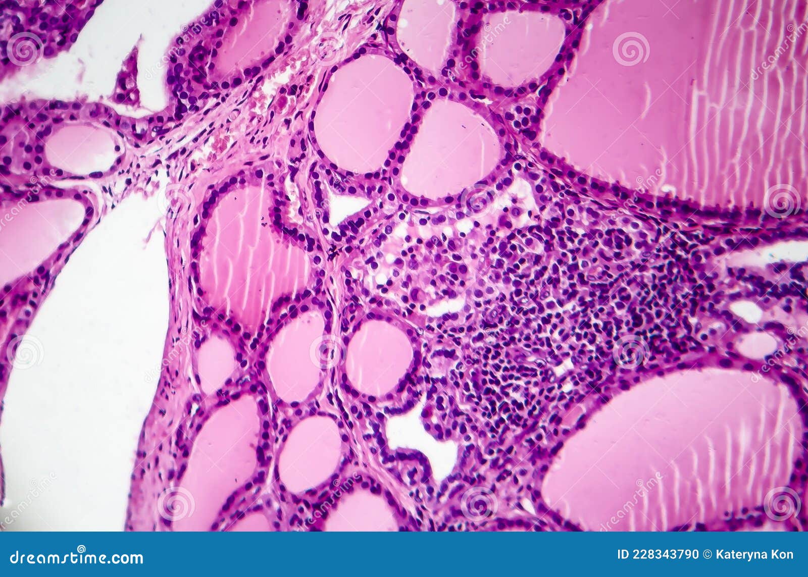 Toxic Diffuse Goiter, or Graves Disease, Light Micrograph Stock Photo ...