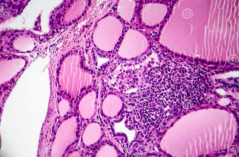 Toxic Diffuse Goiter, or Graves Disease, Light Micrograph Stock Photo ...