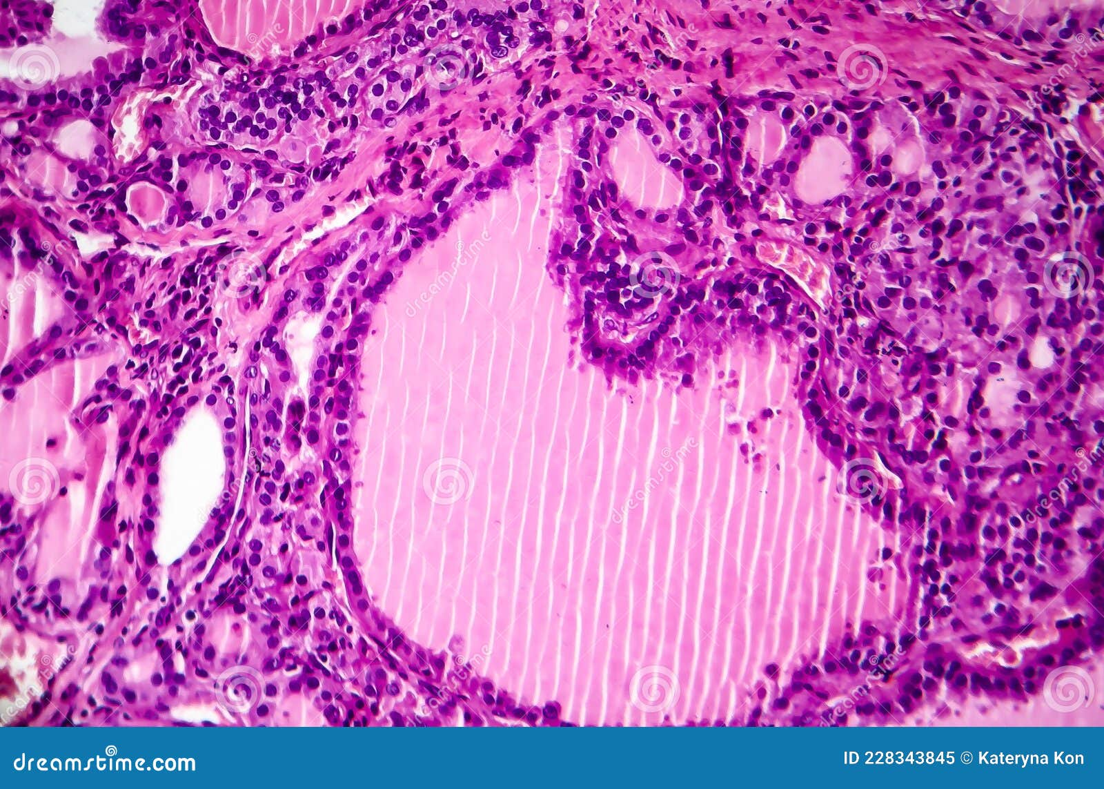 Toxic Diffuse Goiter, or Graves Disease, Light Micrograph Stock Image ...