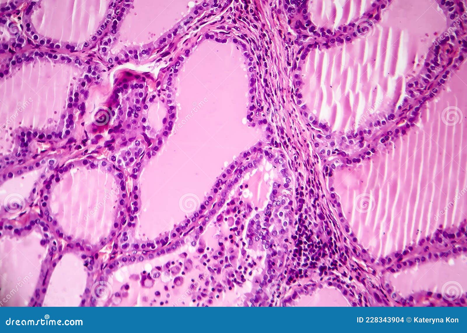 Toxic Diffuse Goiter, or Graves Disease, Light Micrograph Stock Photo ...
