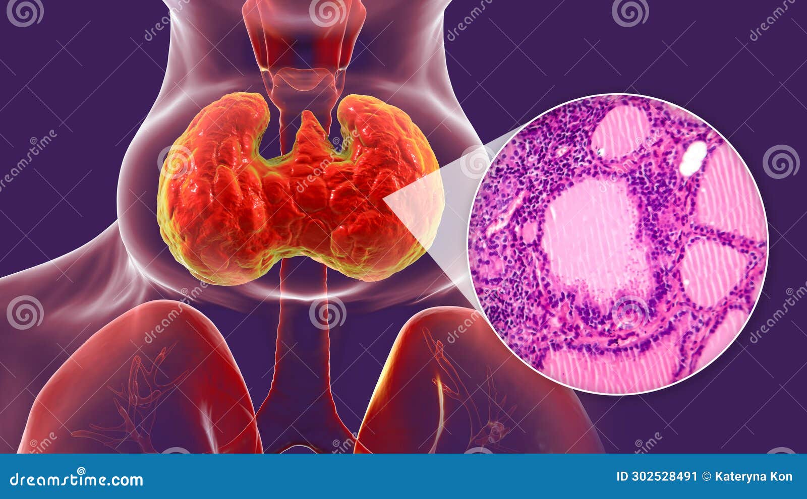 Toxic Goiter, 3D Illustration and Micrograph Stock Illustration ...