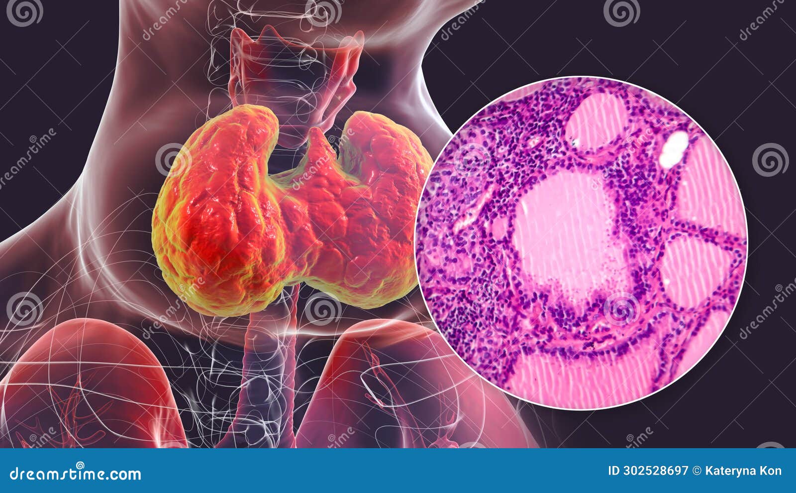 Toxic Goiter, 3D Illustration and Micrograph Stock Illustration ...