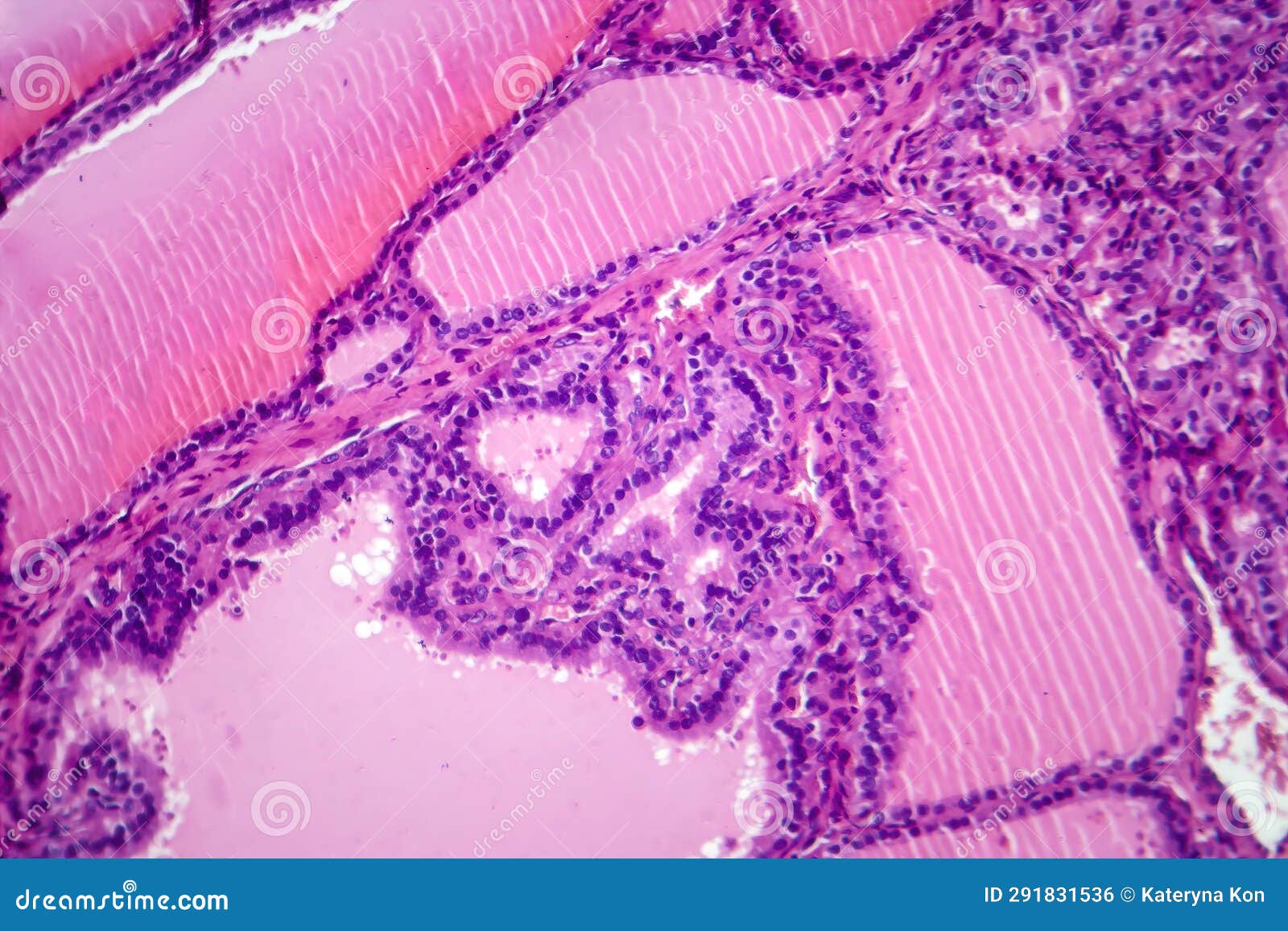 Toxic Goiter, Light Micrograph Stock Photo - Image of thyroid, disorder ...