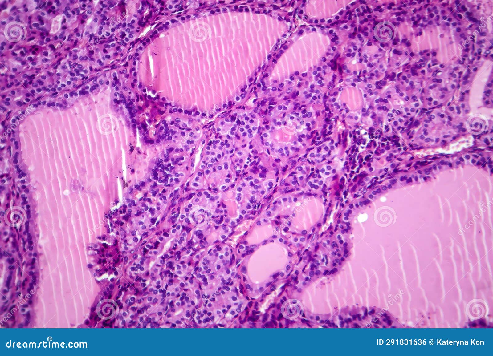 Toxic Goiter, Light Micrograph Stock Photography | CartoonDealer.com ...