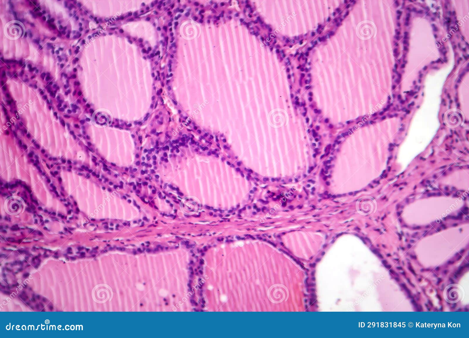 Toxic Goiter, Light Micrograph Stock Image - Image of tissue, pathology ...