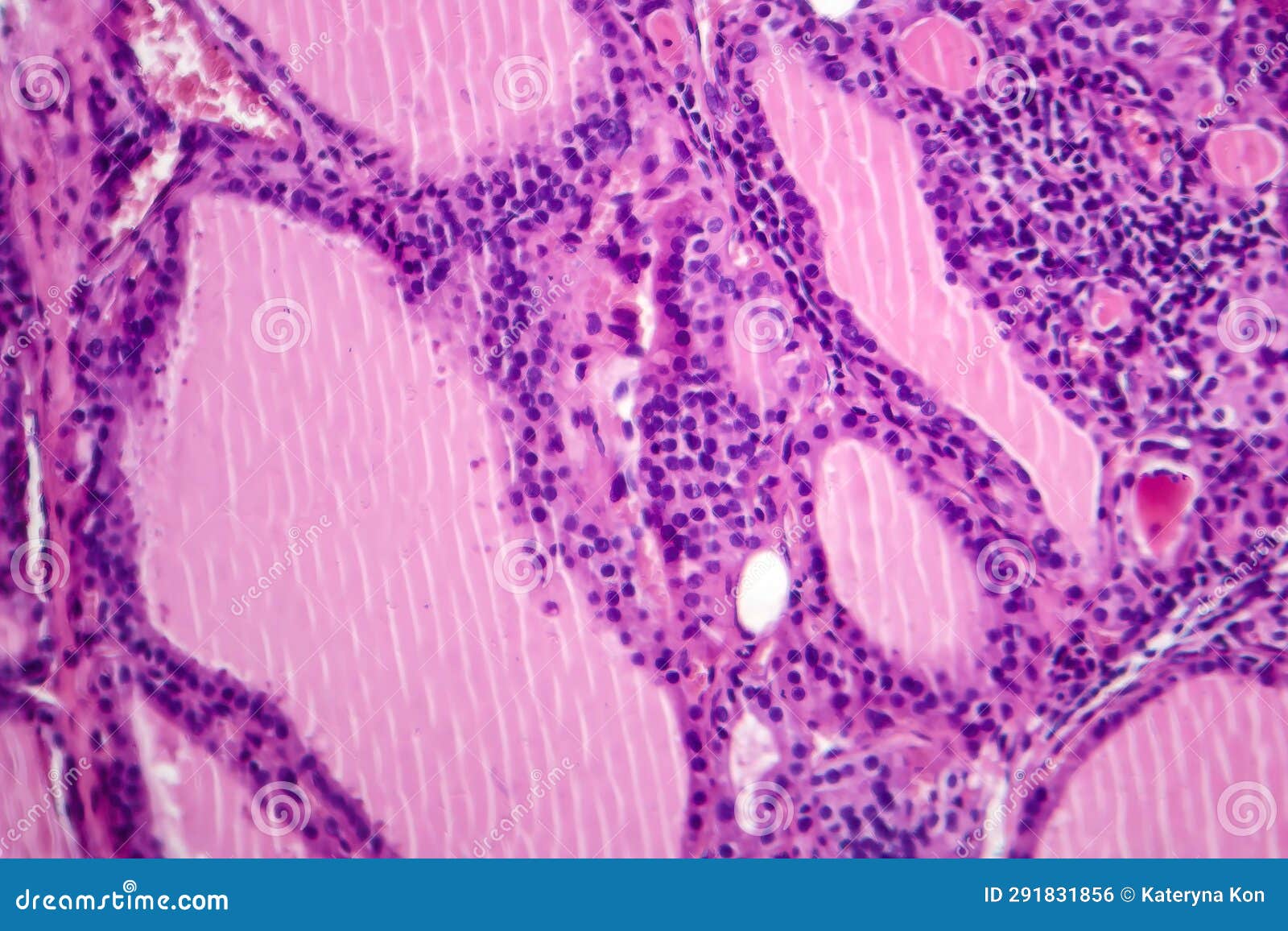 Toxic Goiter, Light Micrograph Stock Photo | CartoonDealer.com #291831990