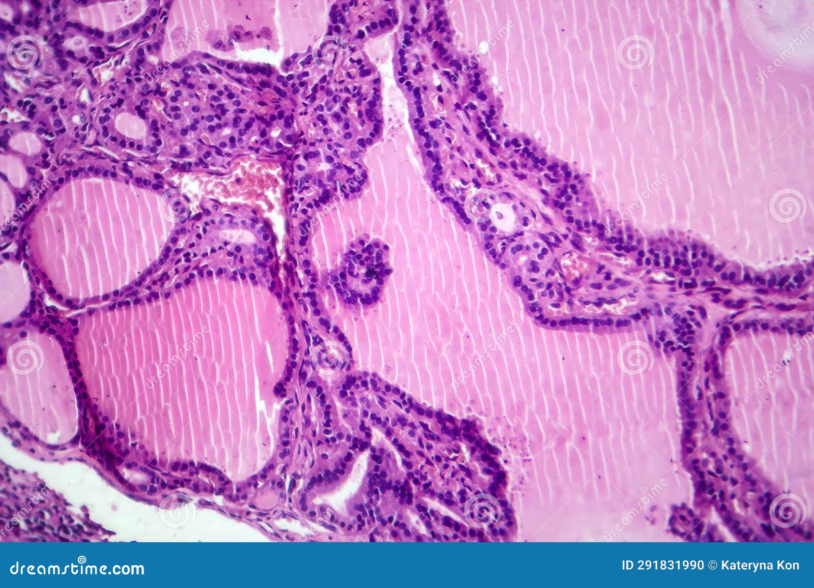 Toxic Goiter, Light Micrograph Stock Photo - Image of examination ...