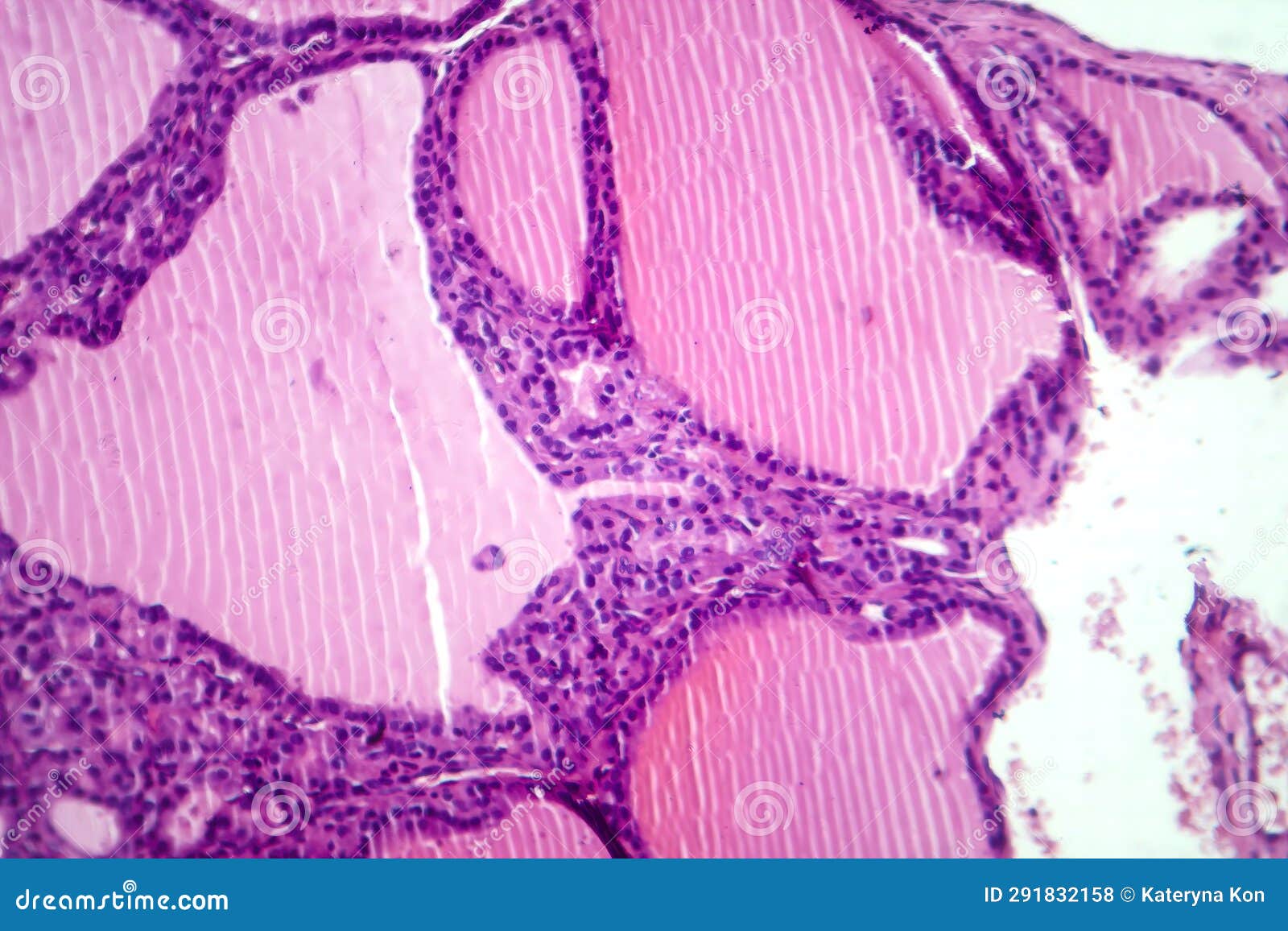 Toxic Goiter, Light Micrograph Stock Photo - Image of follicular ...