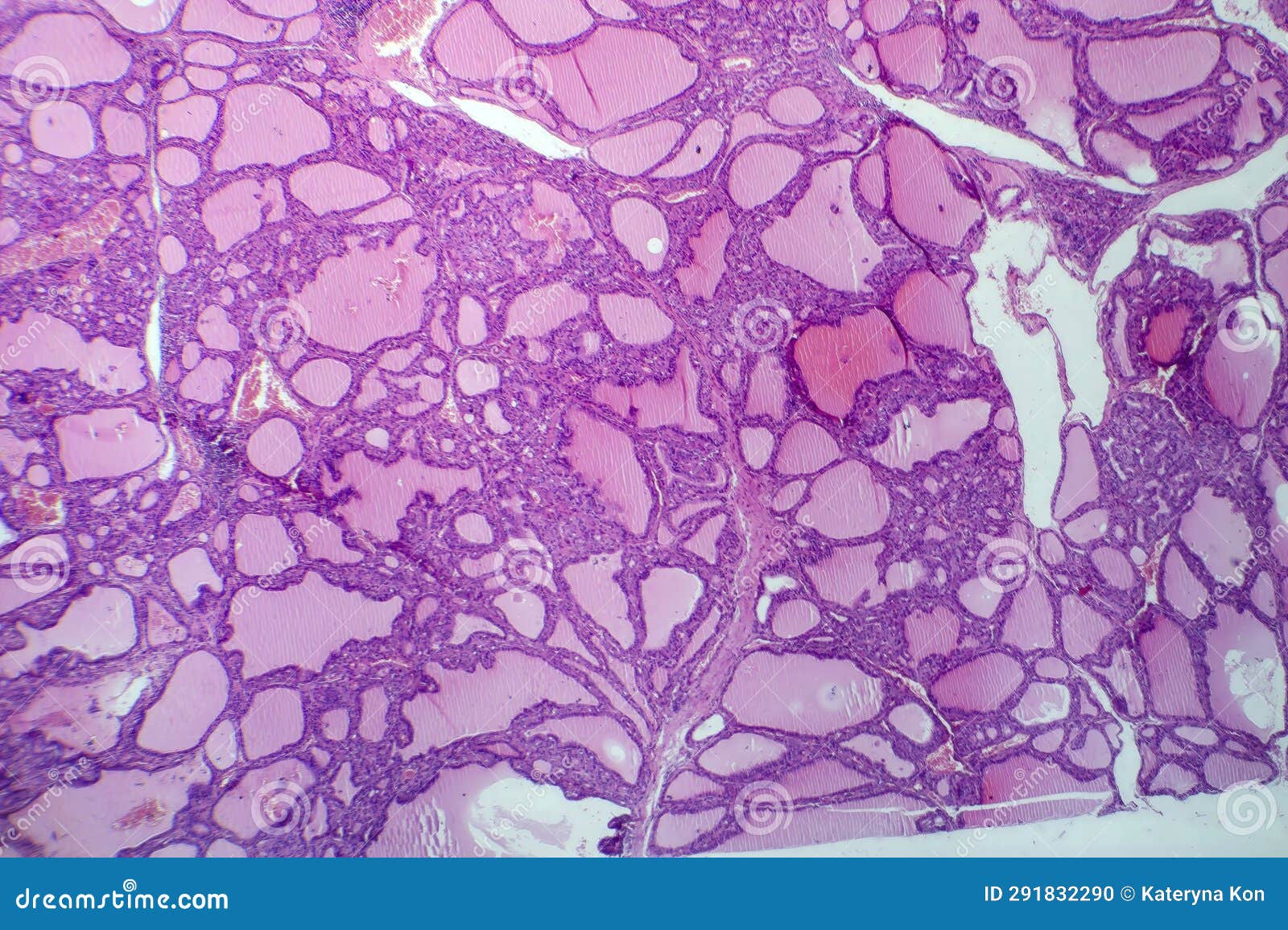 Toxic Goiter, Light Micrograph Stock Photo | CartoonDealer.com #291852264