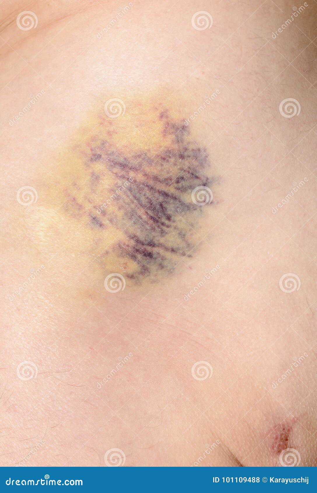 Tracce Di Morso Di Cane E Di Ematoma Alla Natica Fotografia Stock ...