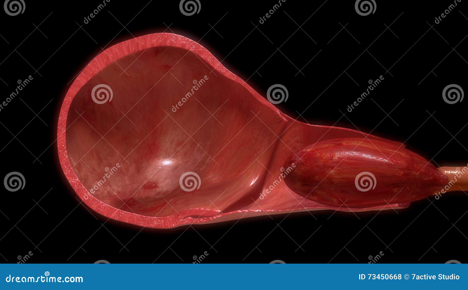 Tracción De La Placenta Fuera Del útero Foto de archivo - Imagen de ...