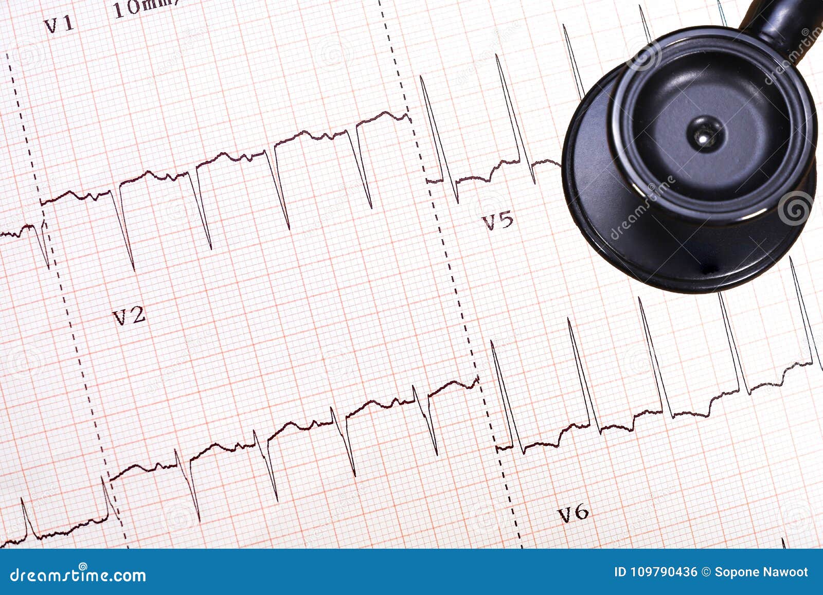 Tracciato Di Elettrocardiogramma Del Cuore Ischemico Fotografia Stock ...