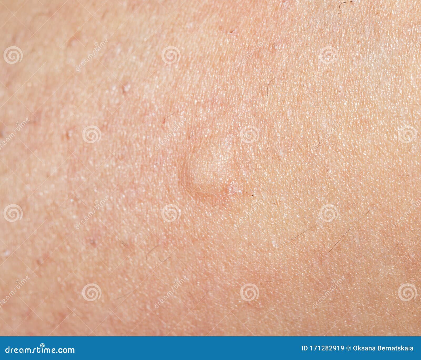 Trace from a Mosquito Bite on the Skin Stock Image - Image of allergy ...