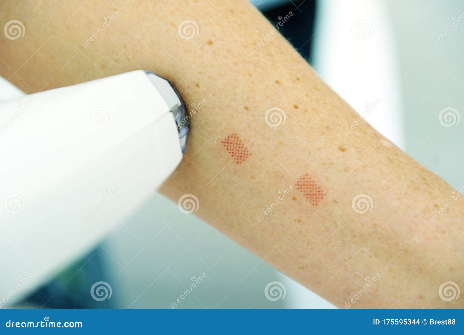 Traces on the Arm from after Laser Therapy Stock Photo - Image of girl ...
