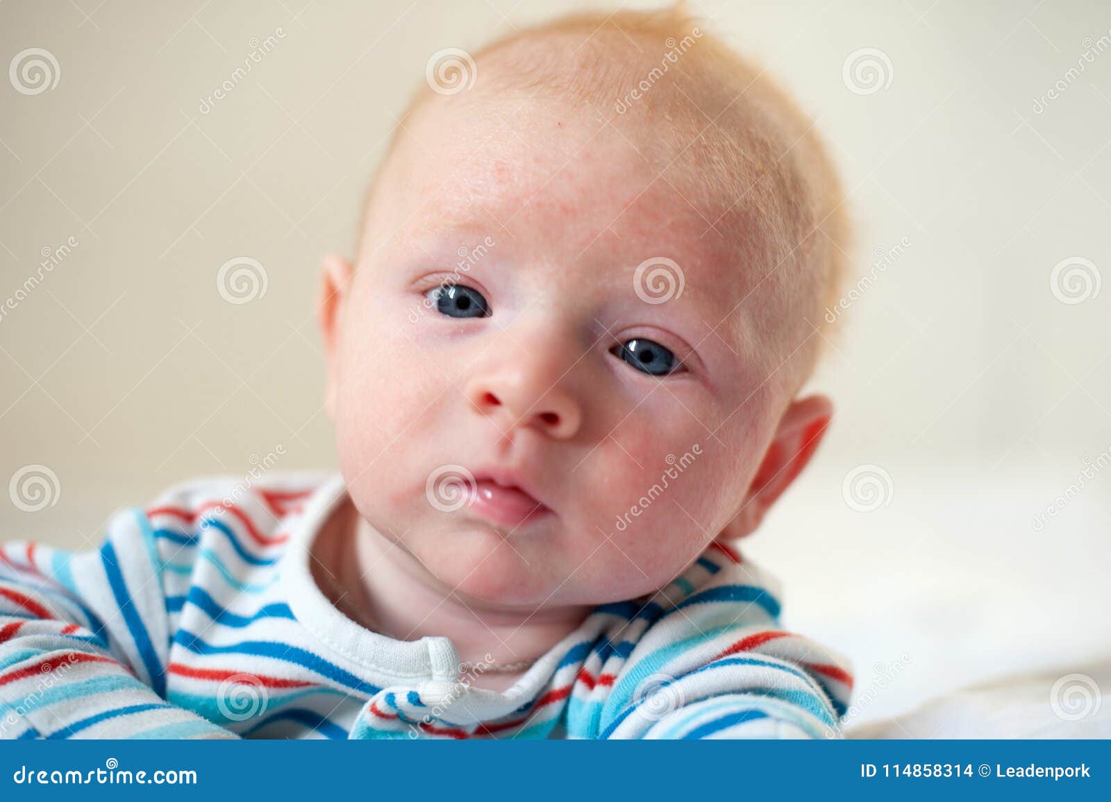 Traces of Diathesis on the Head and Cheeks Stock Photo - Image of ...