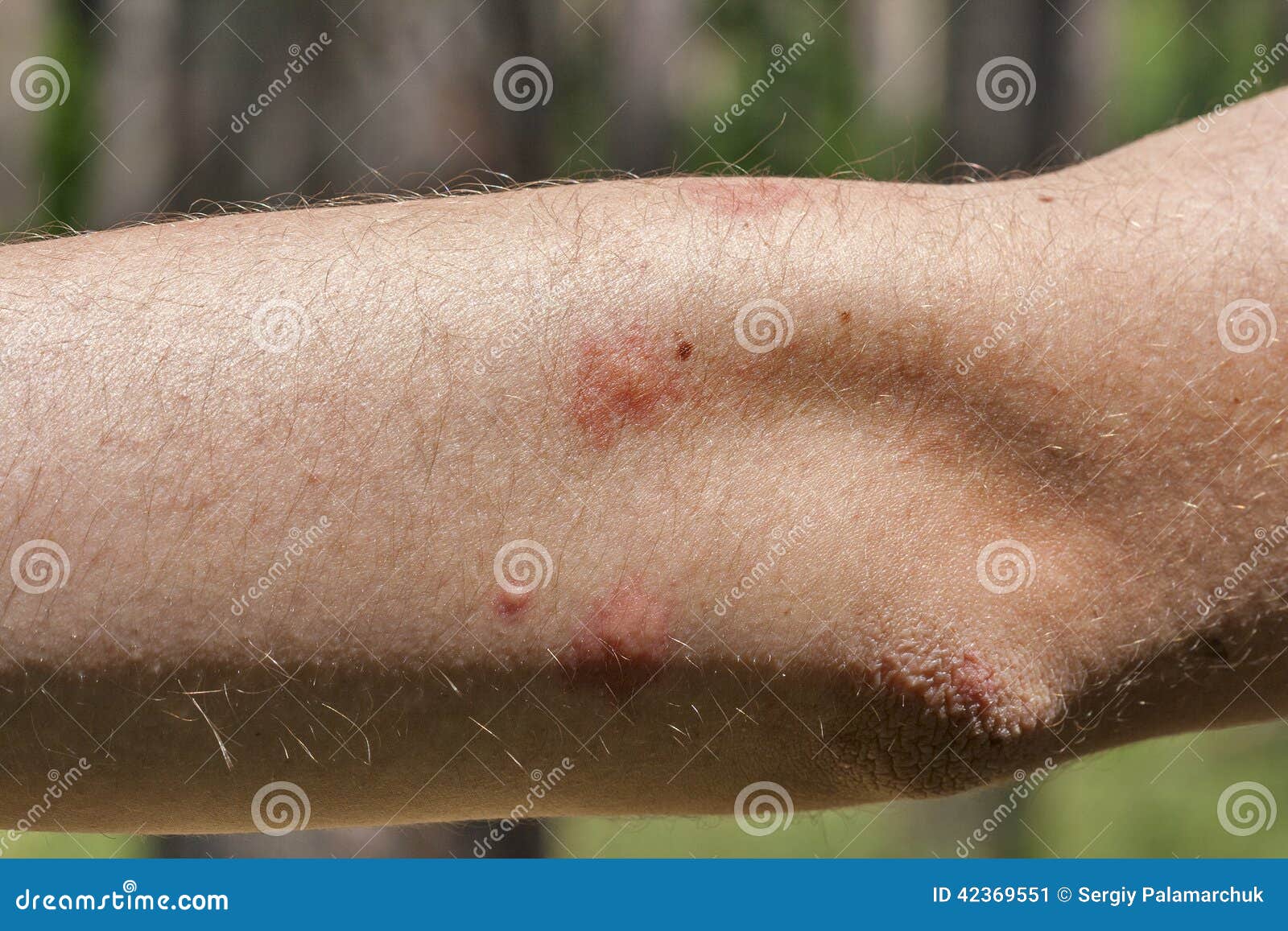 Traces of Mosquito Bites on the Human Elbow Stock Image - Image of ...