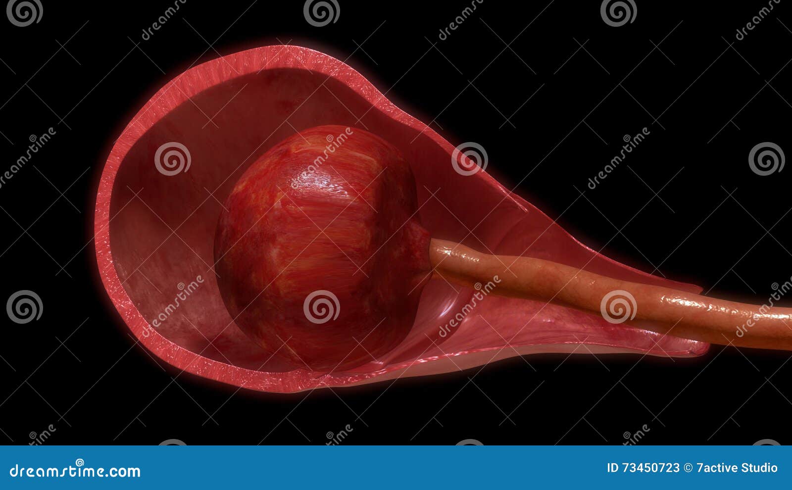 Traction Du Placenta Hors De L'utérus Image stock - Image du foetus ...
