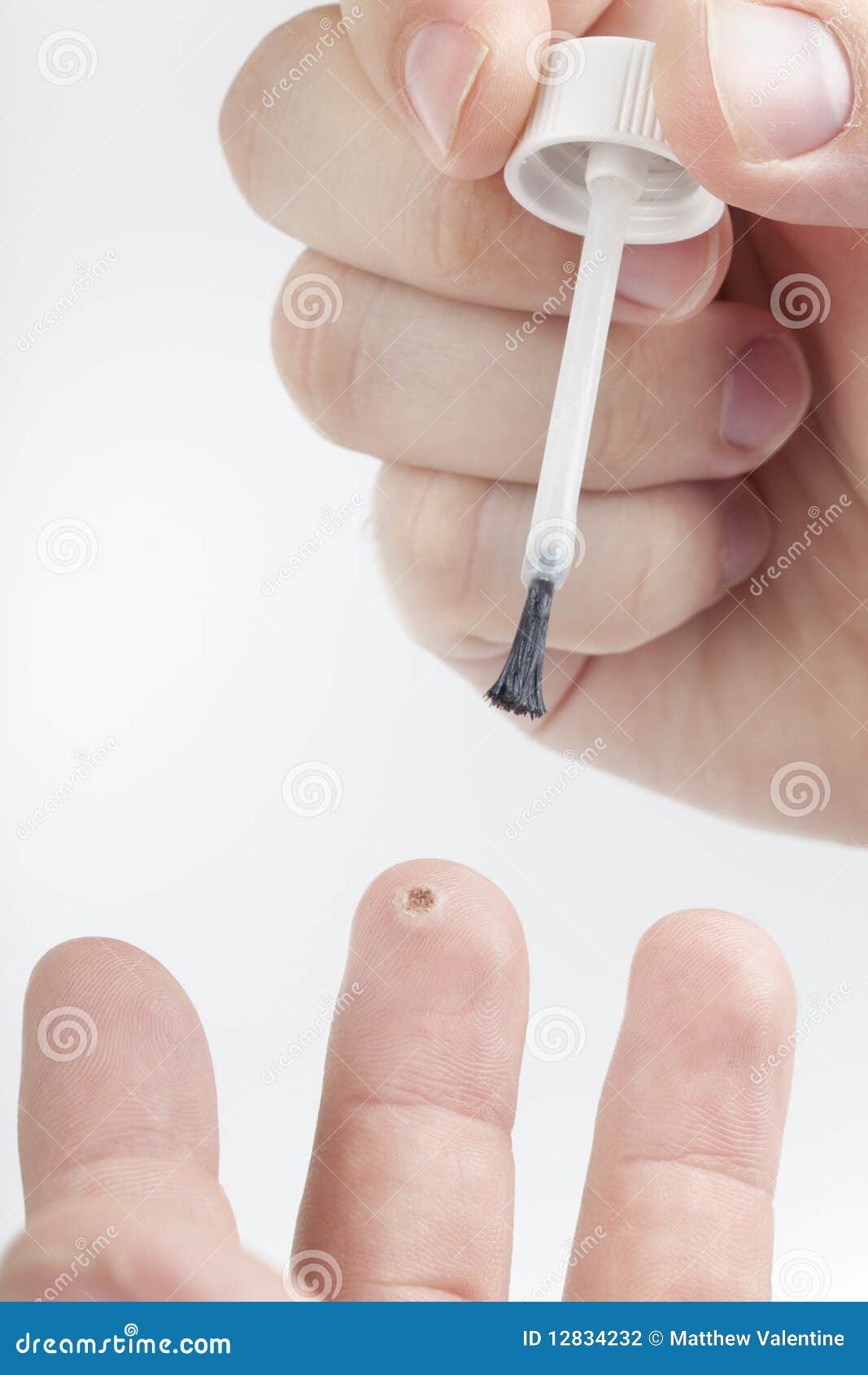 Traitement d'une verrue photo stock. Image du homme, traitement - 12834232