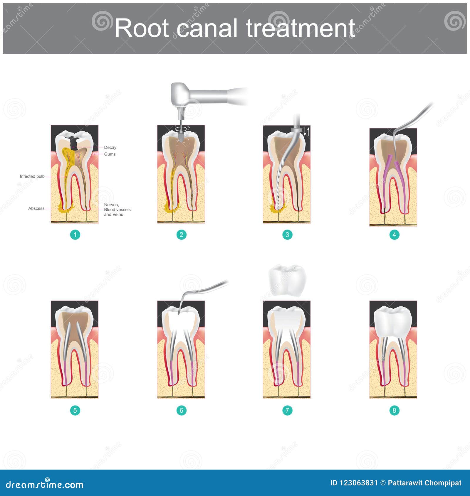 Traitement De Canal Radiculaire Comment Traiter Nos Dents Illustration ...