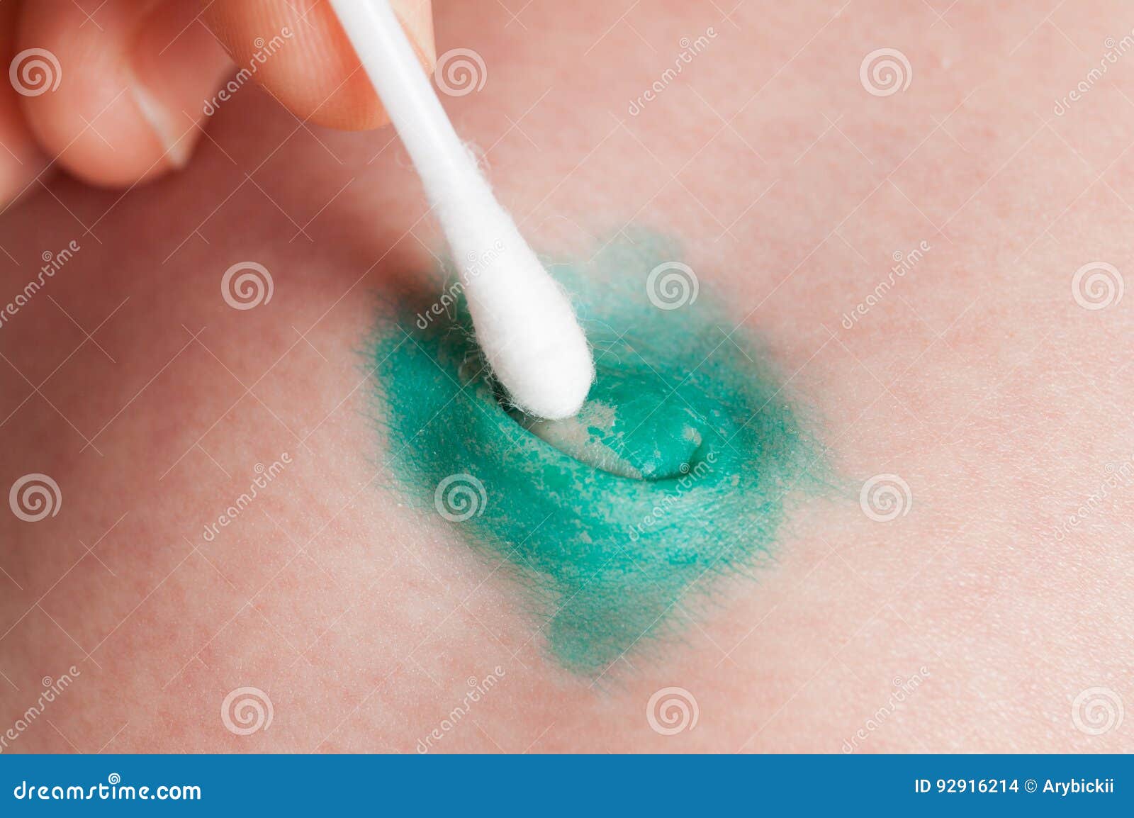 Traitement Du Nombril Du ` S De Bébé Photo stock - Image du fermer ...