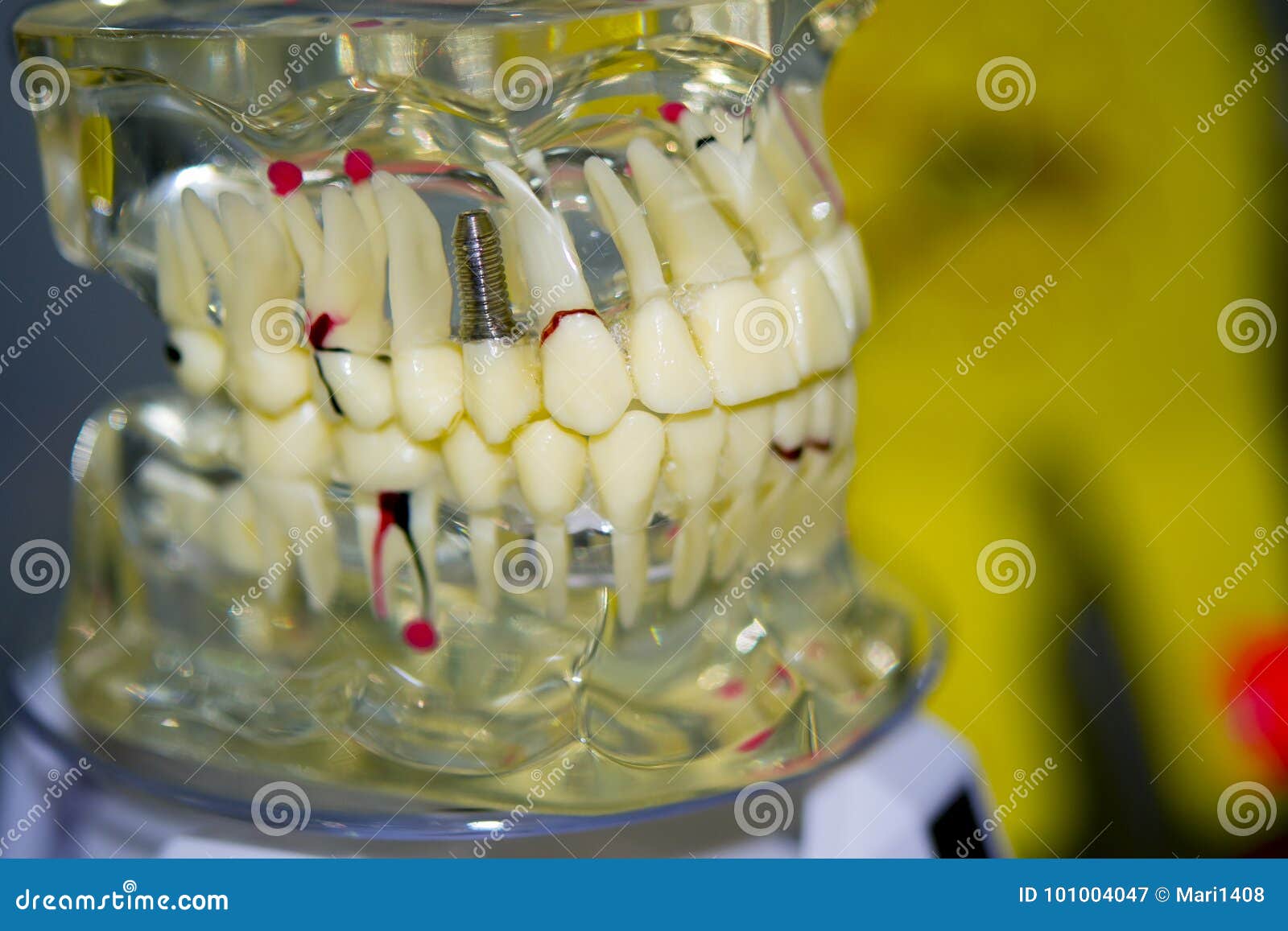 Transparent Model of Human Teeth Stock Image - Image of orthodontist ...