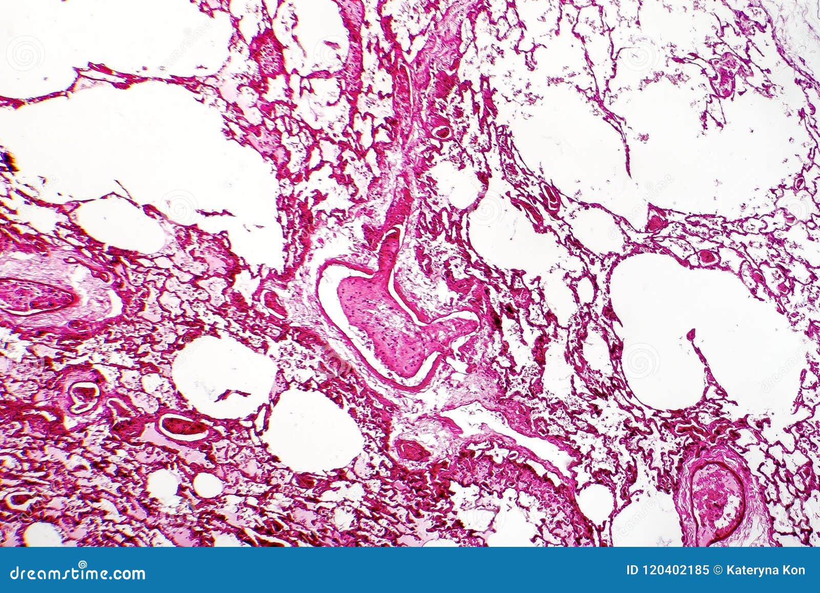 Transparent Thrombosis, Light Micrograph Stock Image - Image of ...
