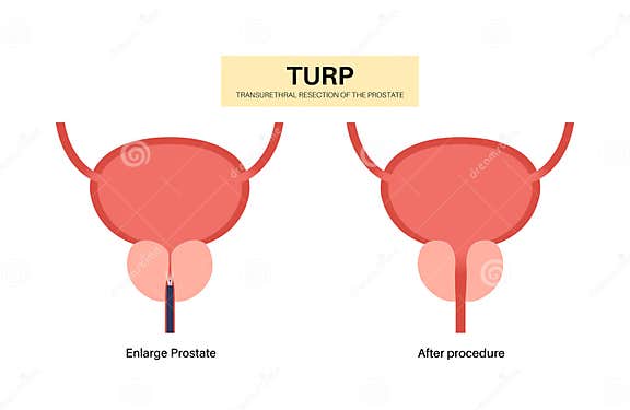 Transurethral Resection Of The Prostate Stock Illustration