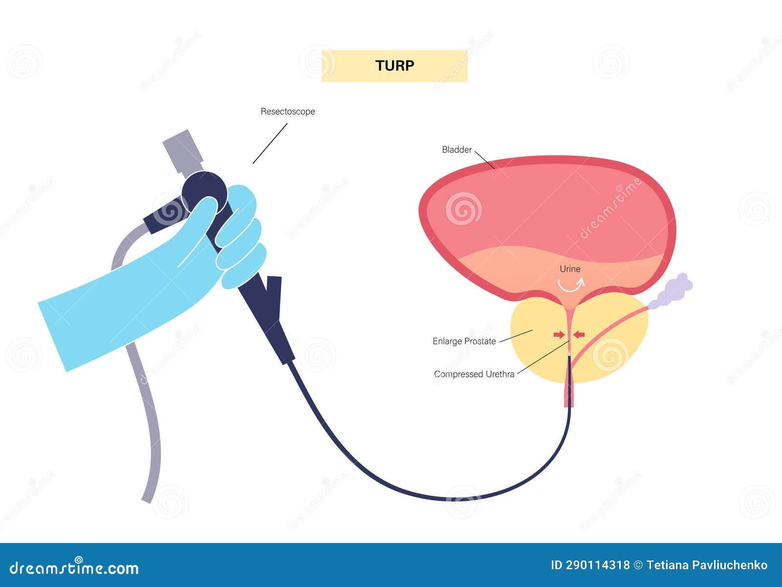 Transurethral Resection Of The Prostate Vector Illustration