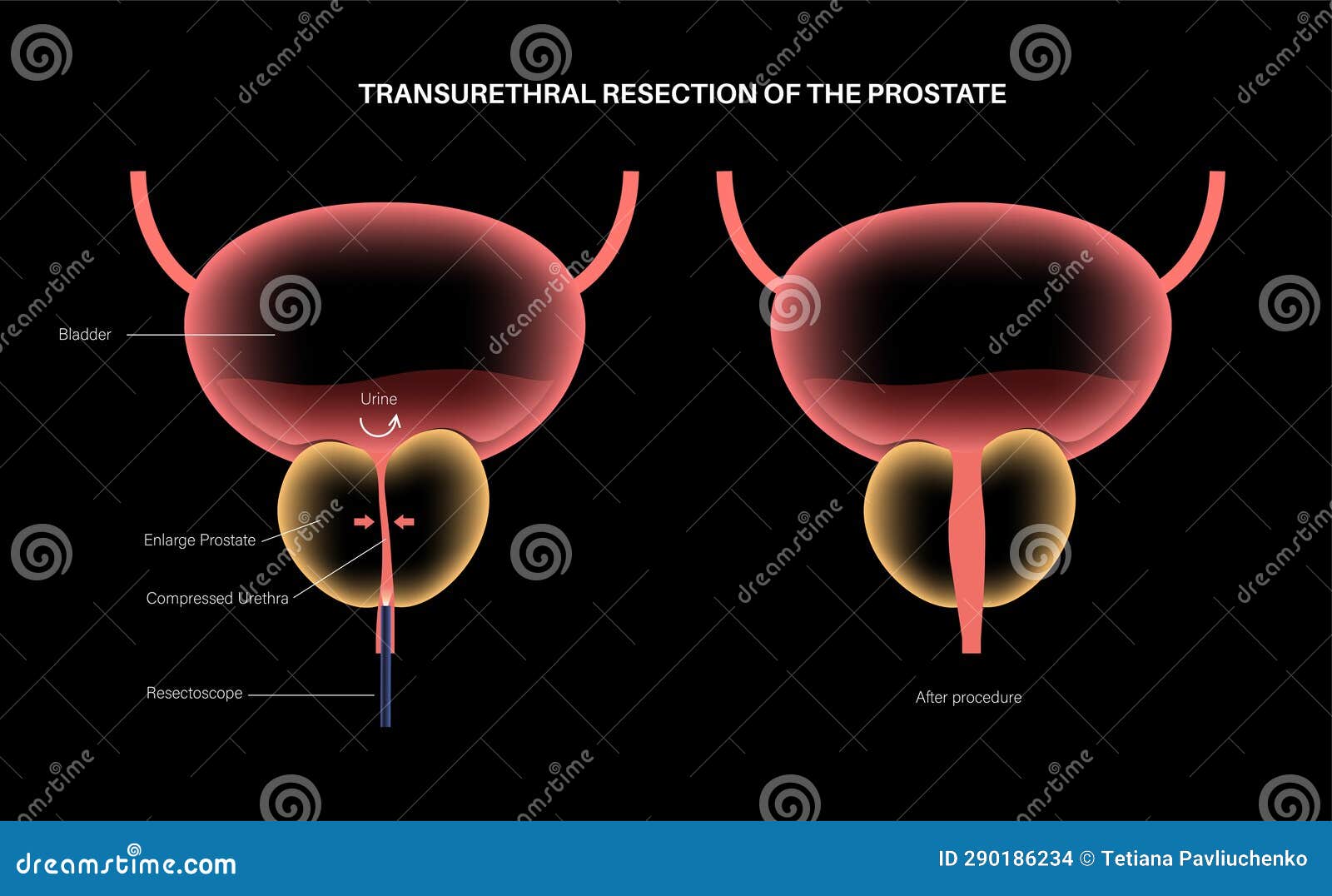 Transurethral Resection Of The Prostate Vector Illustration