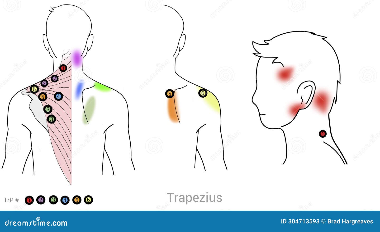 Trapezius Muscle: Managing Pain Arriving From Myofascial Trigger Points ...