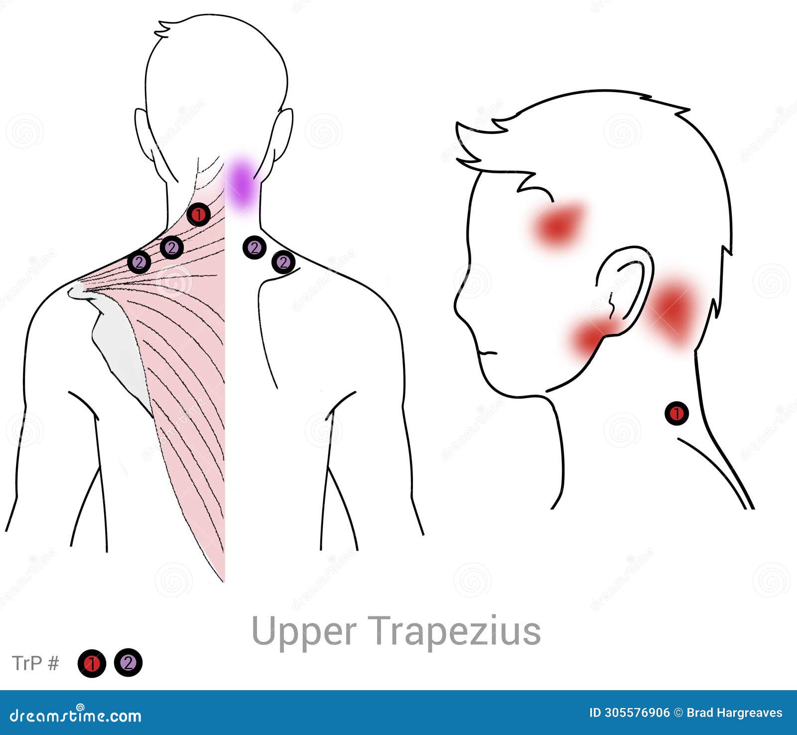Upper Trapezius: Neck and Side Head Pain Stock Illustration ...
