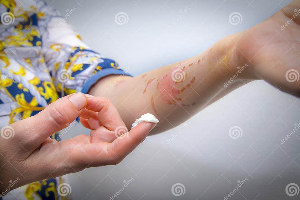 Tratamento Da Pele Queimada Com Creme Foto de Stock - Imagem de ...