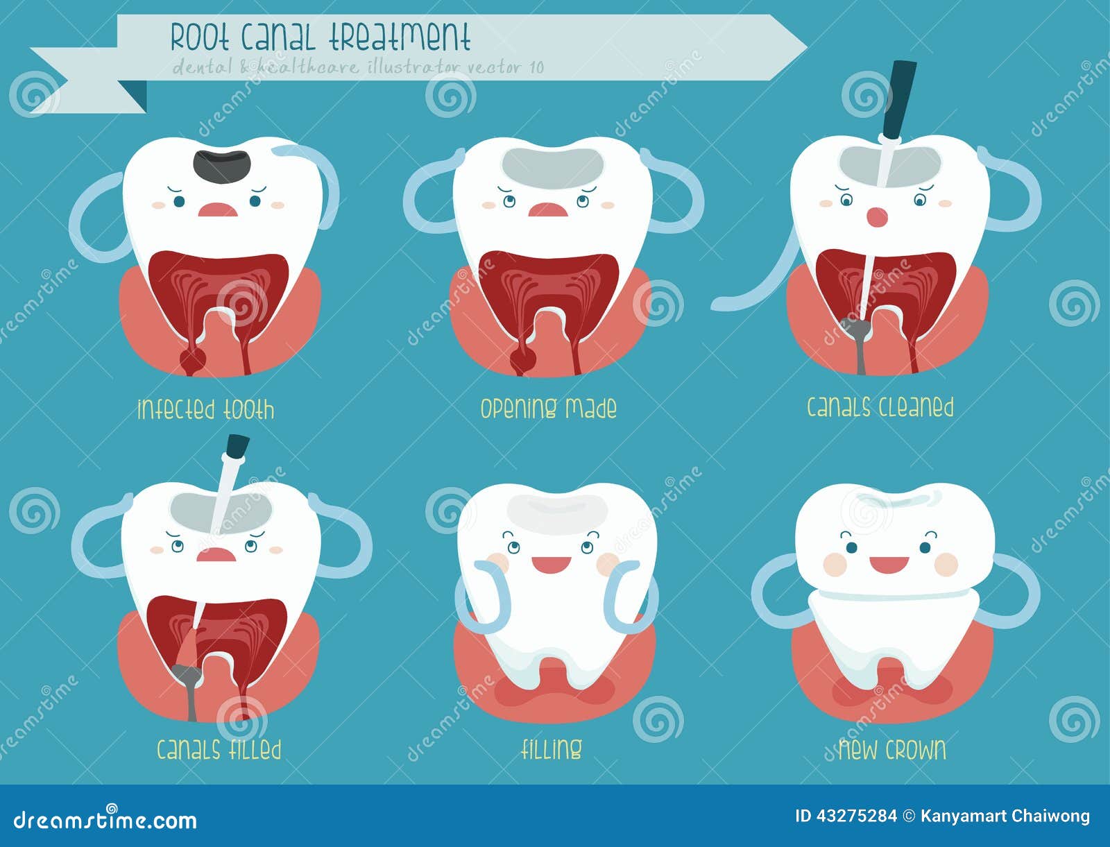 Tratamiento De La Endodoncia Ilustración del Vector - Ilustración de ...