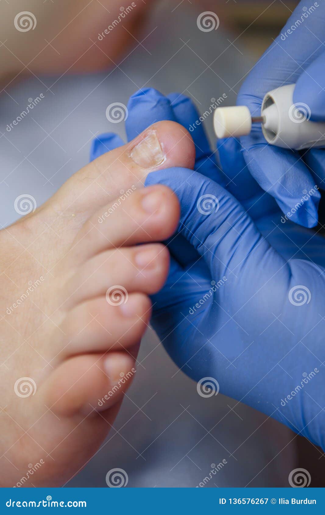 Tratamiento De Podology El Podiatra Trata El Pie E Imagen de archivo ...