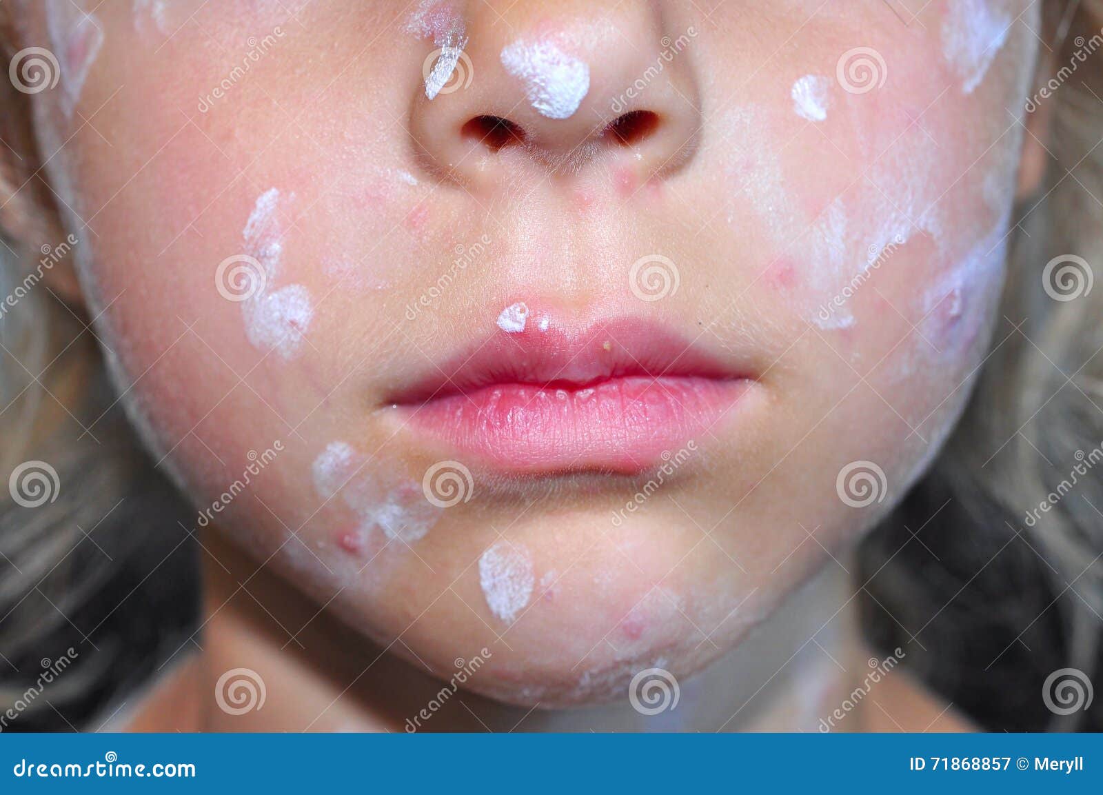 Trattamento di vaiolo immagine stock. Immagine di infezione - 71868857