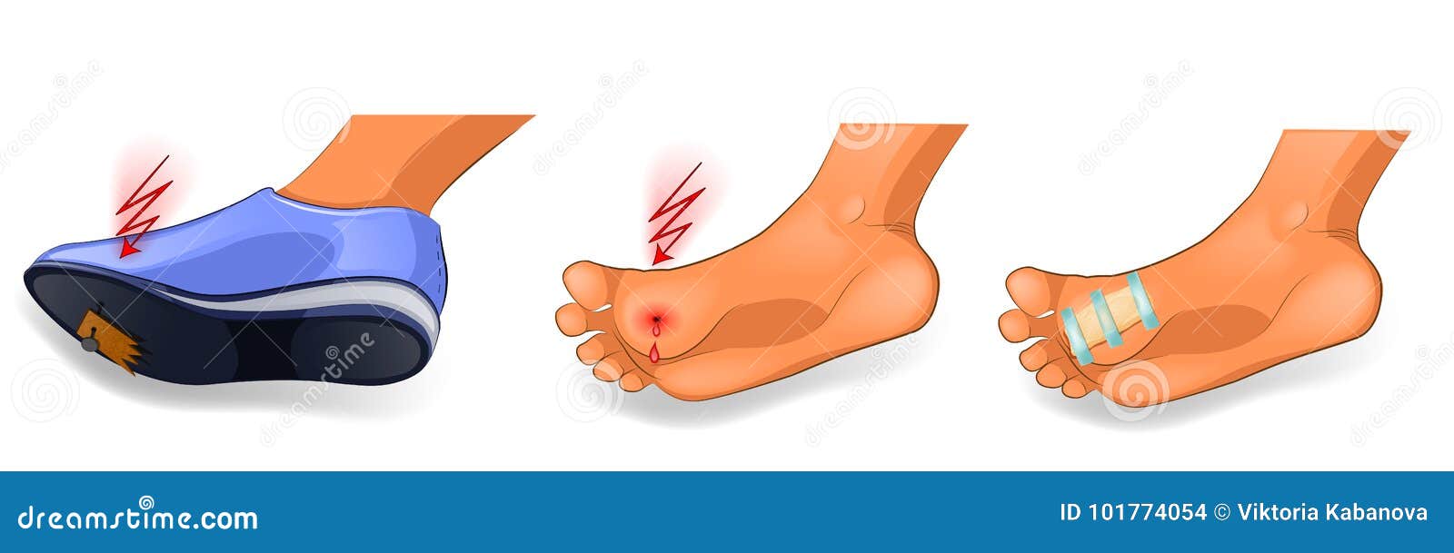 Trauma Al Pie El Clavo En El Pie Ilustración del Vector - Ilustración ...