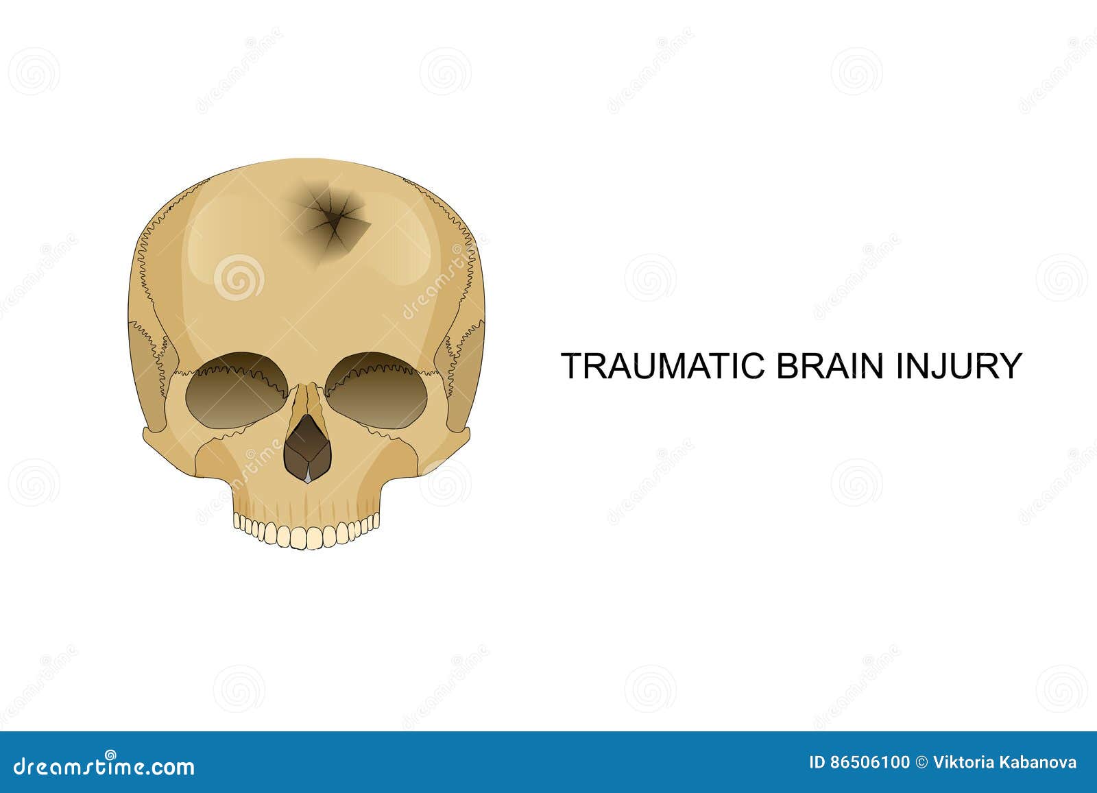 Traumatic Brain Injury Banner. Head Injury Treatment. Vector Signs For ...