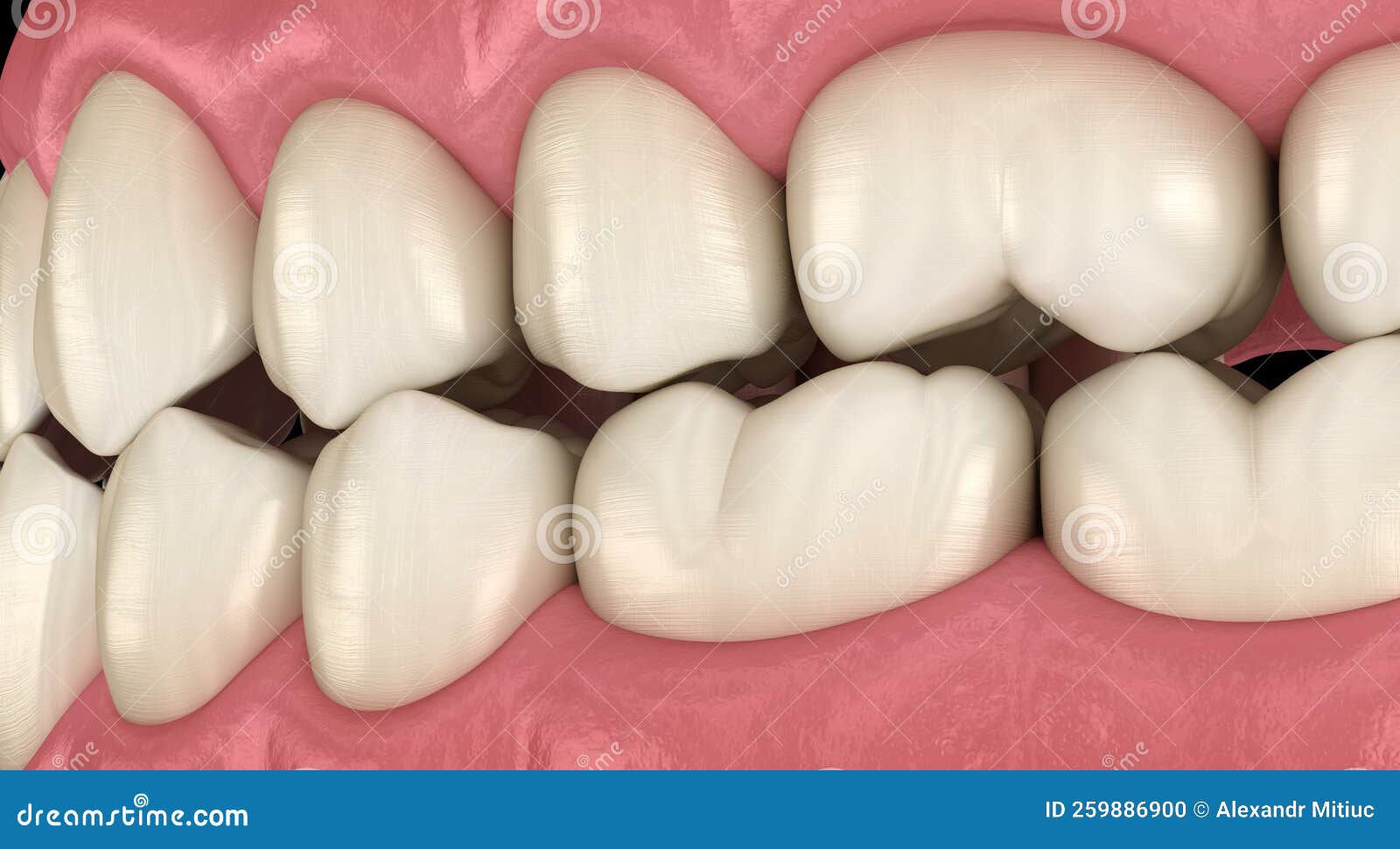 Traumatic Occlusion. Medically Accurate 3D Illustration Stock ...