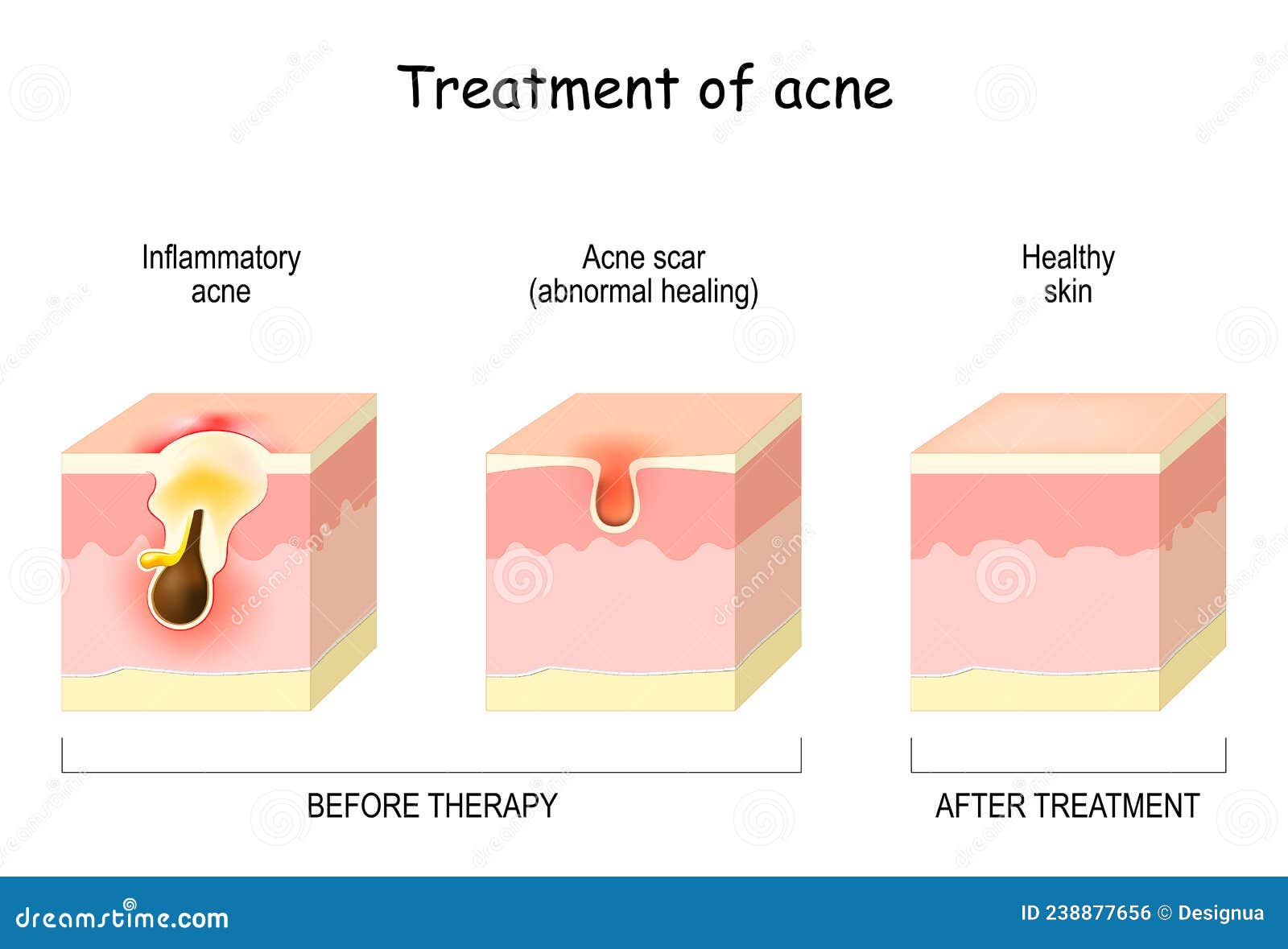 Treatment of Acne. Skin Layers before and after Therapy Stock ...