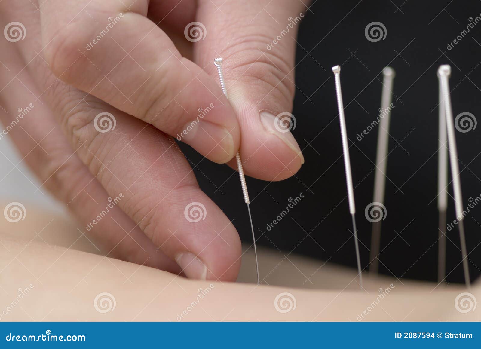 Treatment by acupuncture stock photo. Image of medical - 2087594