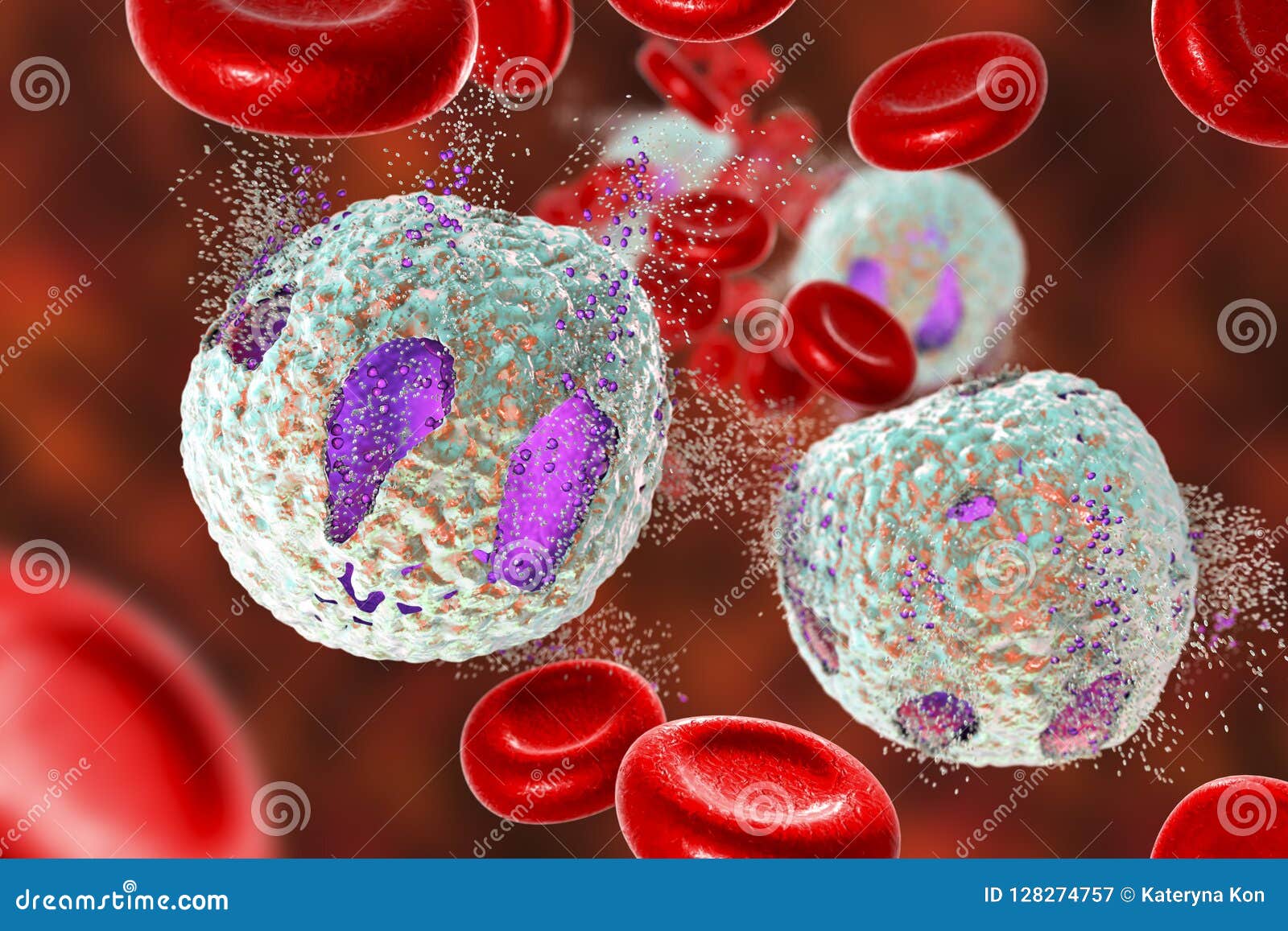 Acute Lymphoblastic Leukemia, Bone Marrow Smear Stock Illustration ...