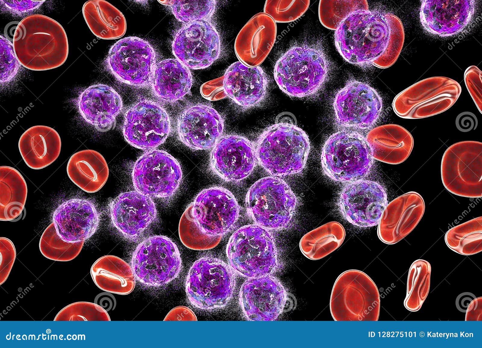 Treatment of Acute Lymphoblastic Leukemia Stock Illustration ...