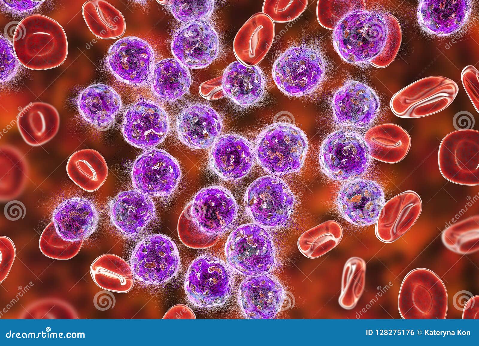 Acute Lymphoblastic Leukemia, Bone Marrow Smear Royalty-Free Cartoon ...