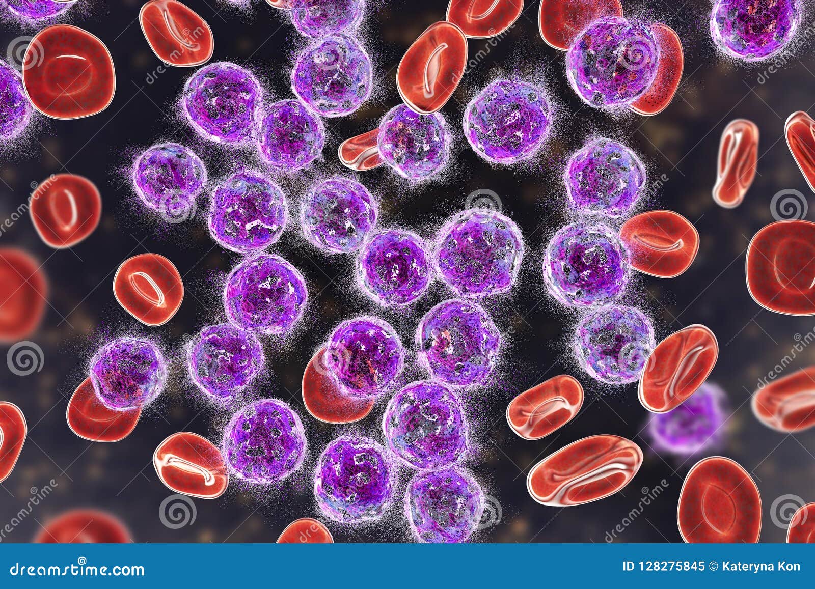Acute Lymphoblastic Leukemia, Bone Marrow Smear Stock Illustration ...