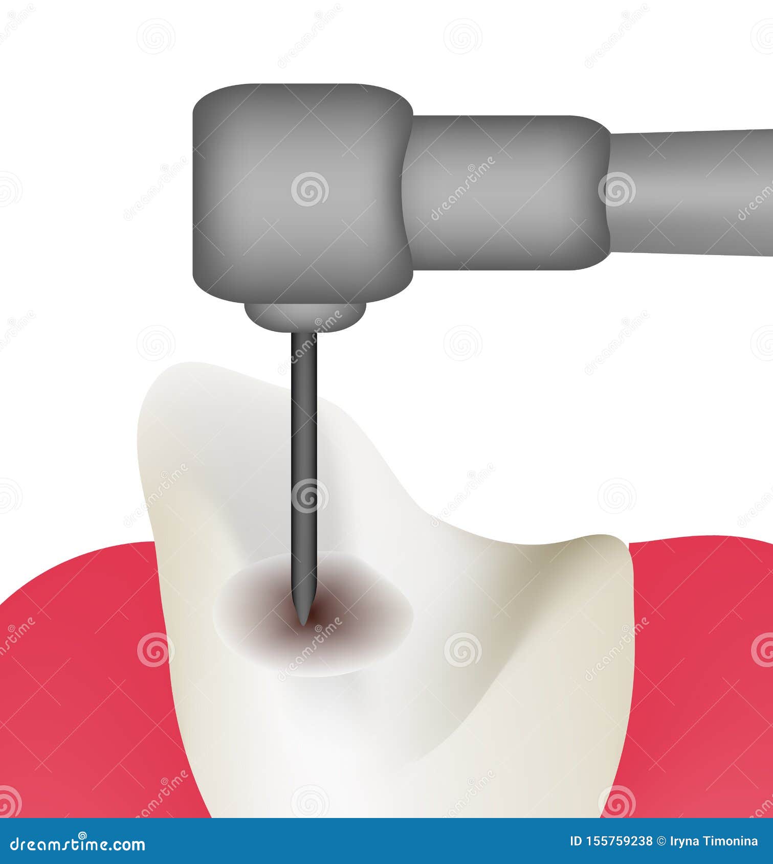 Treatment Of Caries. Drilling A Tooth. Sealing Of The Tooth ...