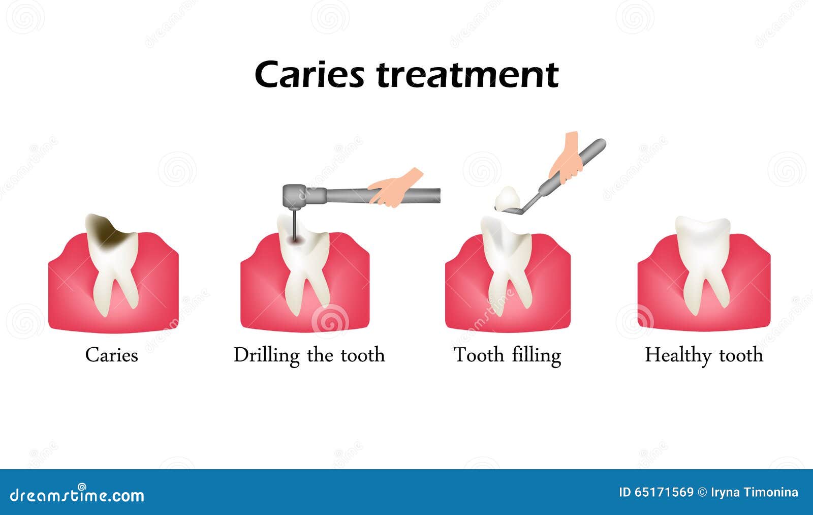 Treatment Of Caries Drilling A Tooth Sealing Of The Tooth