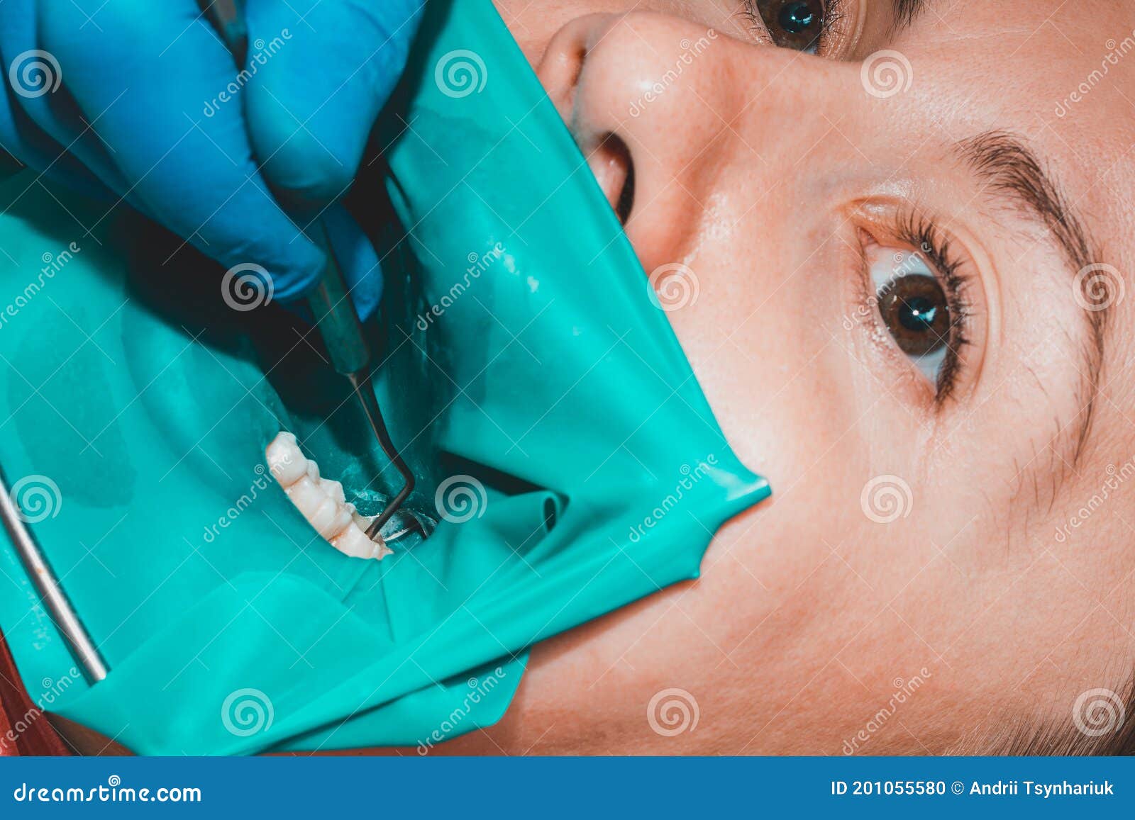 Treatment of a Chewing Tooth, the Dentist Put a Rubber Dam, Uses ...