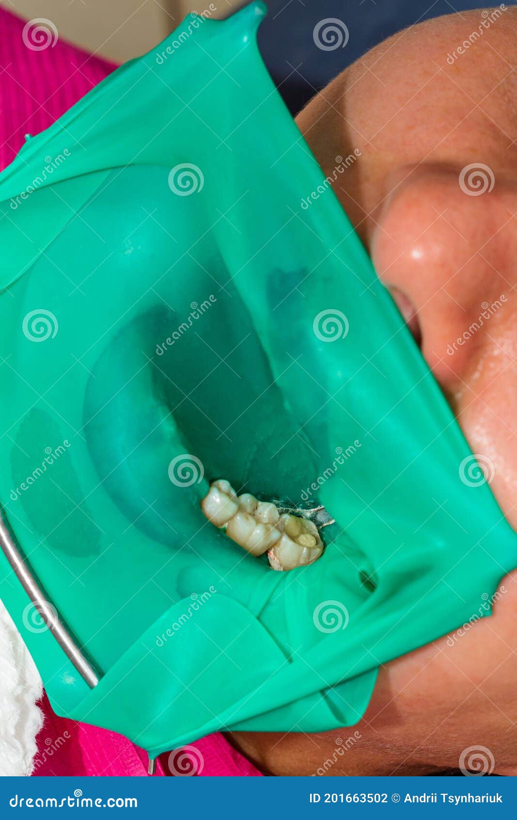Treatment of a Chewing Tooth, the Dentist Put a Rubber Dam, Uses ...